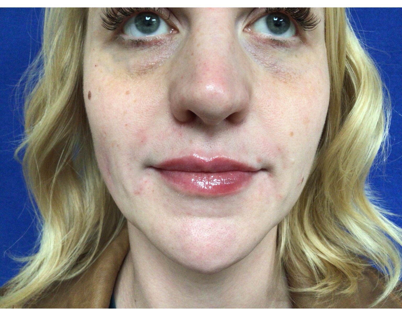 Before-After Gallery - Puyallup Dermatology